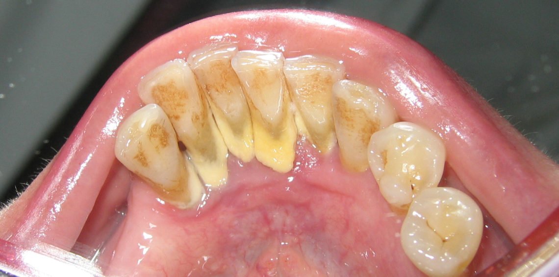 WHAT YOU NEED TO KNOW ABOUT TOOTH PLAGUE | EveryEvery
